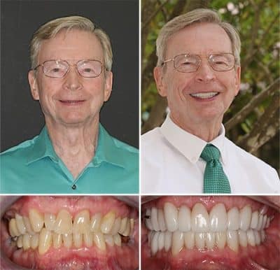 TMJ Treatment Savannah | Beyond Exceptional Dentistry